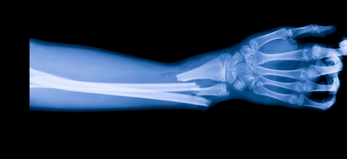 Broken Bones | Orthopedics Rock Hill SC